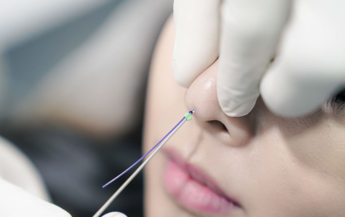 Elevate Your Look with a Nose Thread Lift | Westwood Clinic