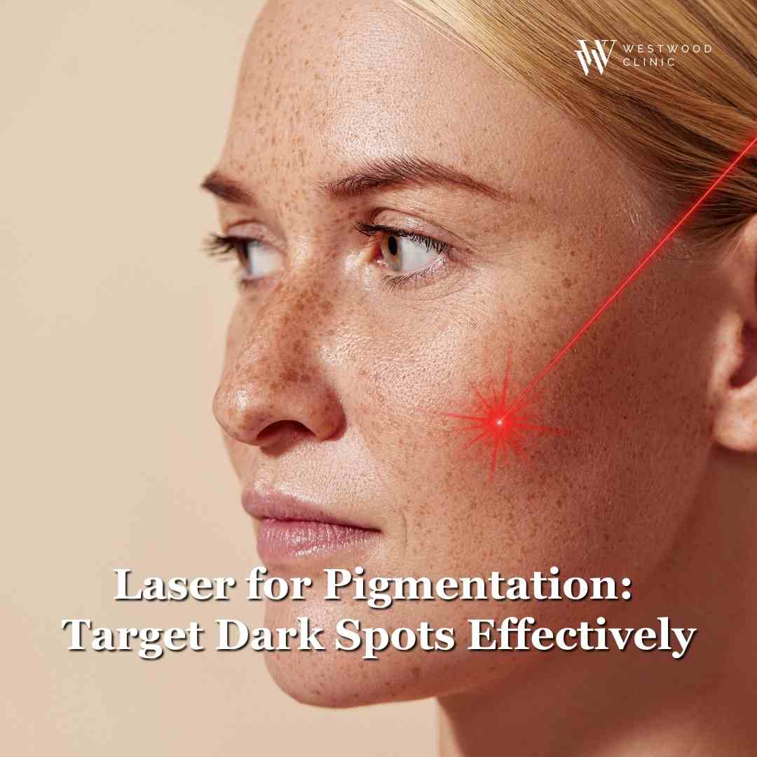 Laser for Pigmentation: Target Dark Spots Effectively