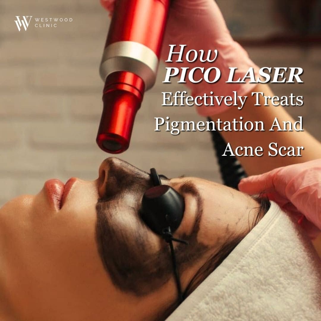 How Pico Laser Effectively Treats Pigmentation and Acne Scar